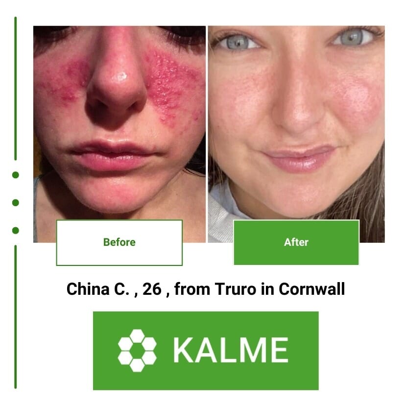 Kalme Day Defence SPF40 | Rosaceea Day Cream | Skin Shop