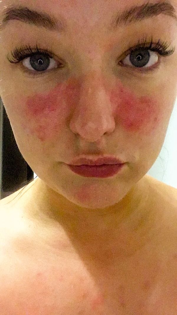 Teacher's rosacea triggered by Christmas gift is finally cleared with cream made from capers ...