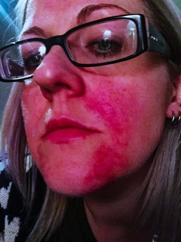 Emotional trauma is the second biggest cause of rosacea