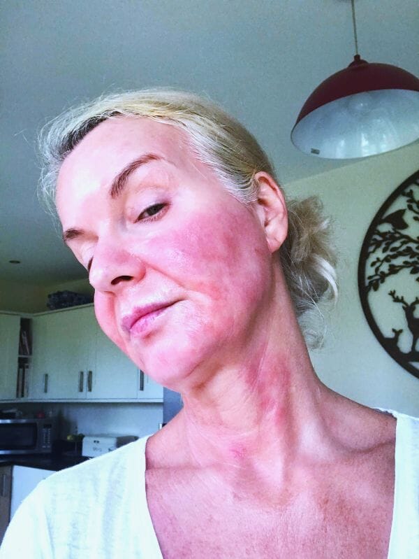 Menopausal eczema almost ruined wedding until a vine gel saved the day!