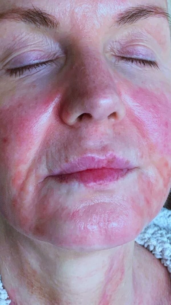 Menopausal eczema almost ruined wedding until a vine gel saved the day!