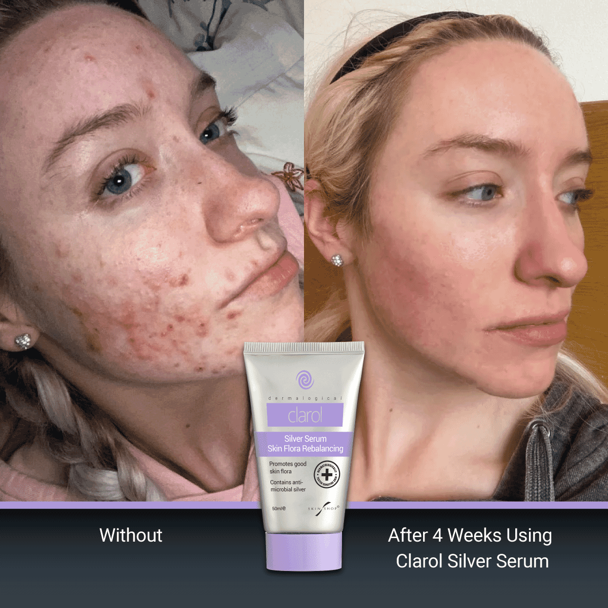 solutions for adult acne