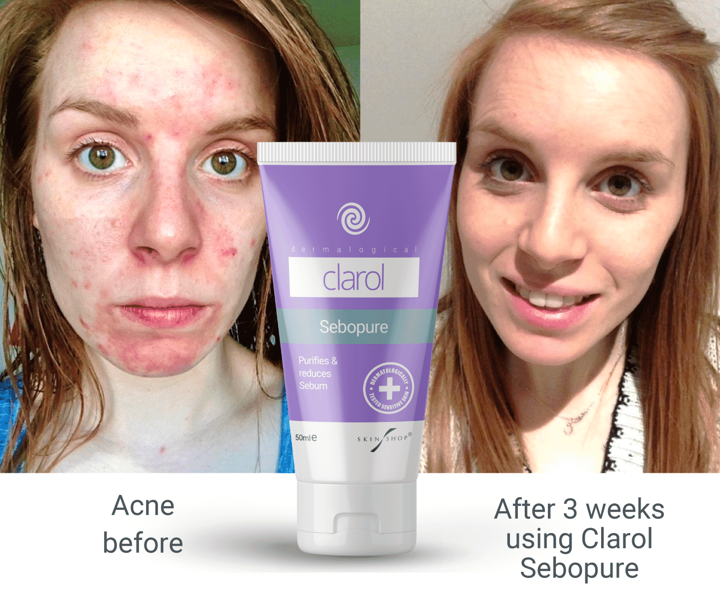 Solutions for oily skin acne and excess sebum