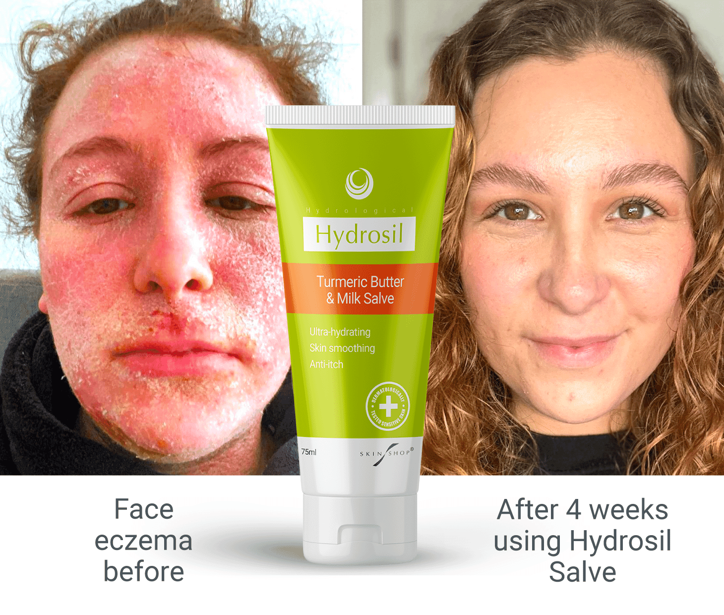 Solutions for face eczema