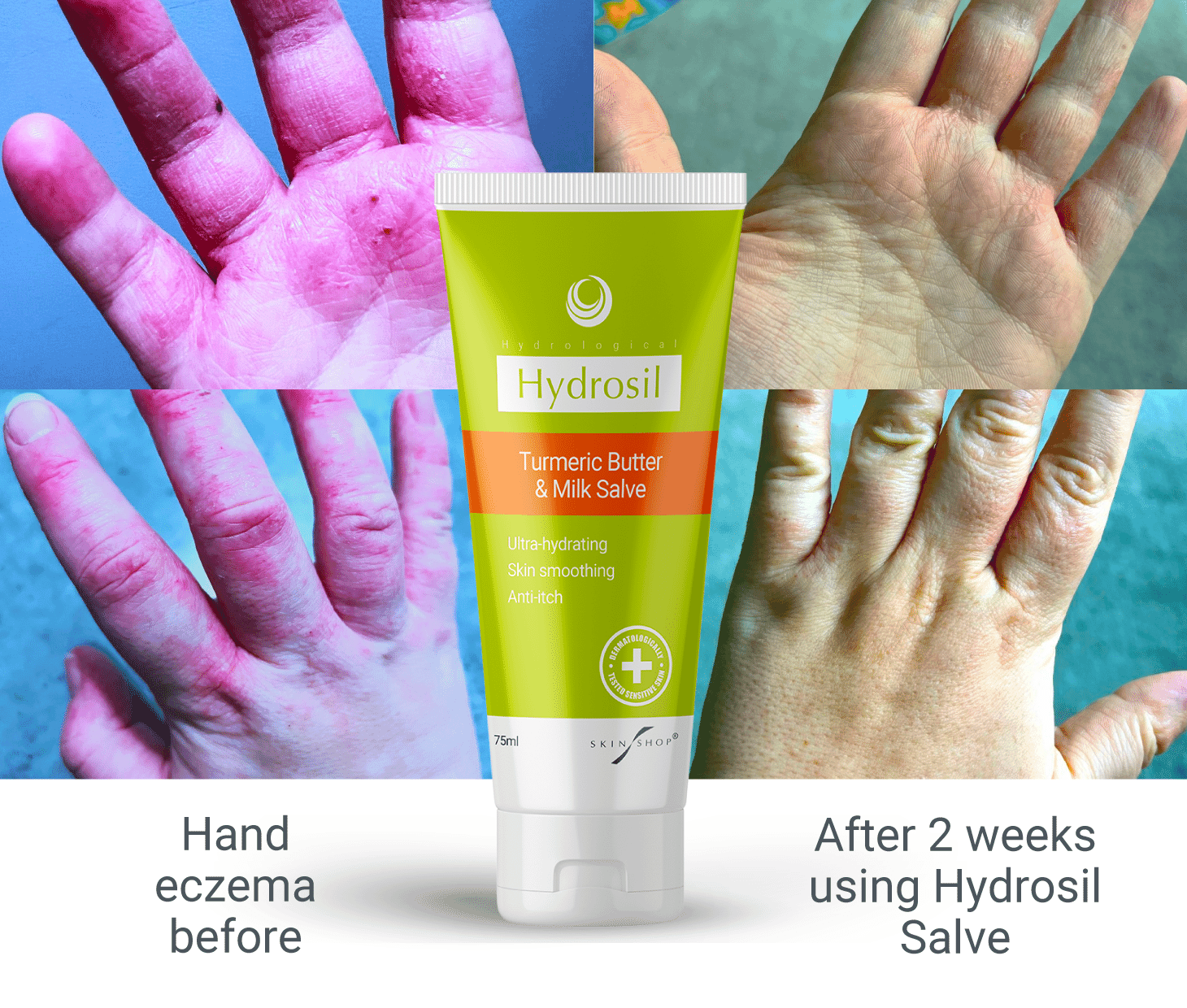 Natural solutions for hand eczema