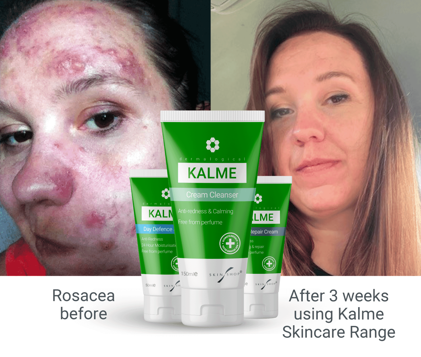 Natural solution for rosacea