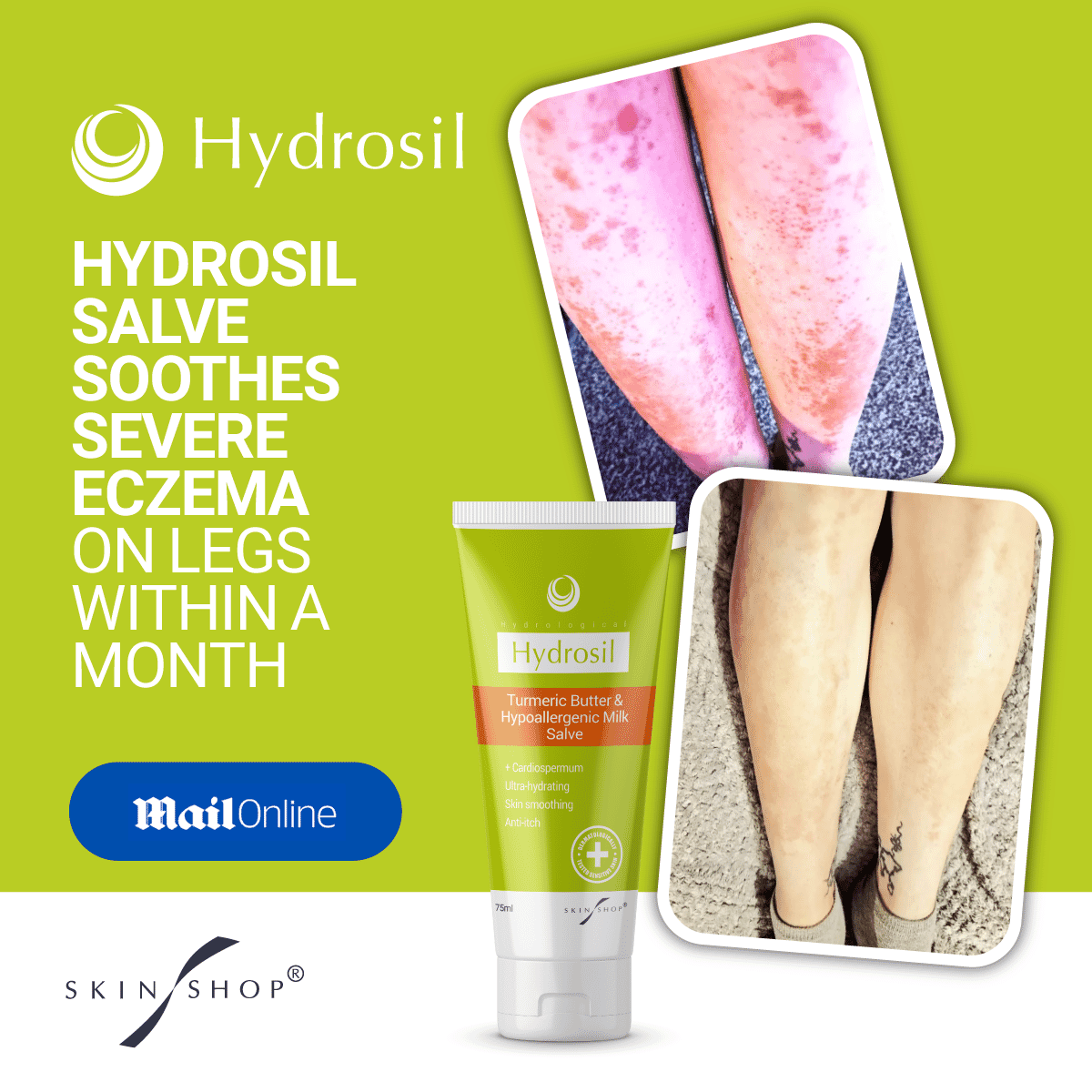 Natural solutions for leg eczema